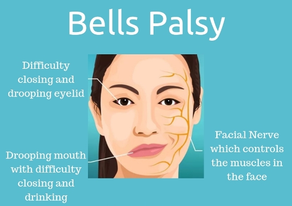 Terapi Listrik Bell’s Palsy, Meningkatkan Pemulihan Otot Wajah