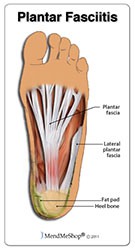 JUMPER'S KNEE (PATELLAR TENDONITIS). Peradangan Tendon Lutut