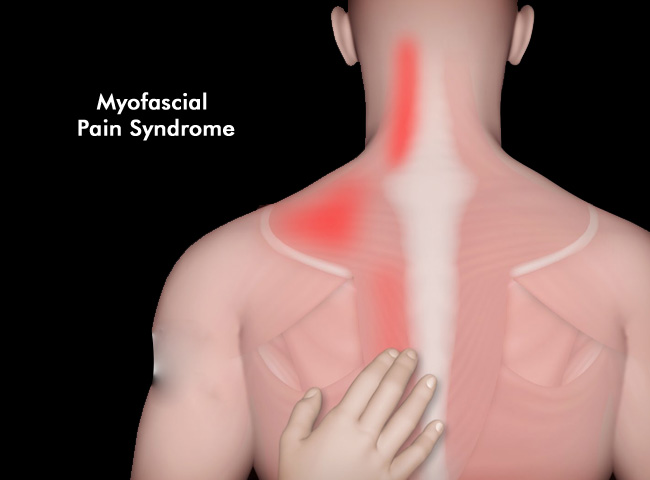 Myofascial Pain Syndrome