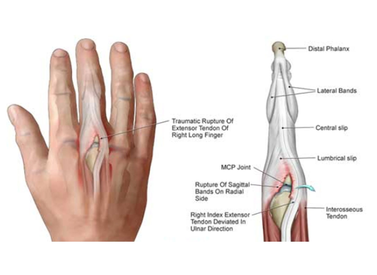 Kenalan Sama Boxer’s Knuckle, Cedera Olahraga Pada Petinju