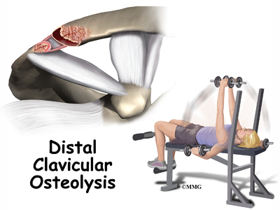 Cedera Bahu Saat Gym , Apa Yang Harus Dilakukan